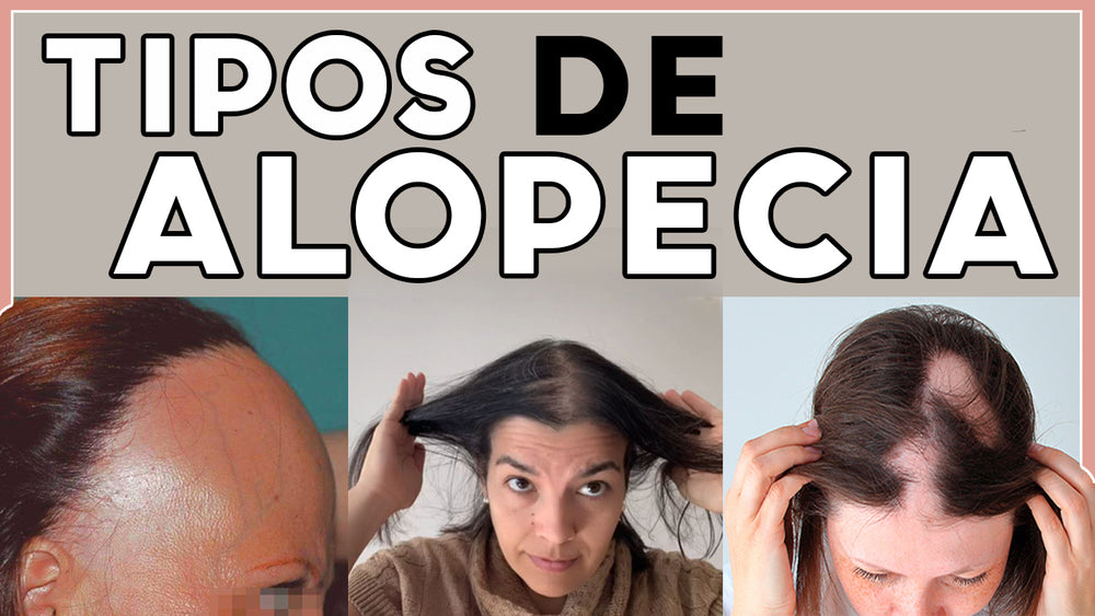 Tipos de Alopecia – Nais Hair Extensiones